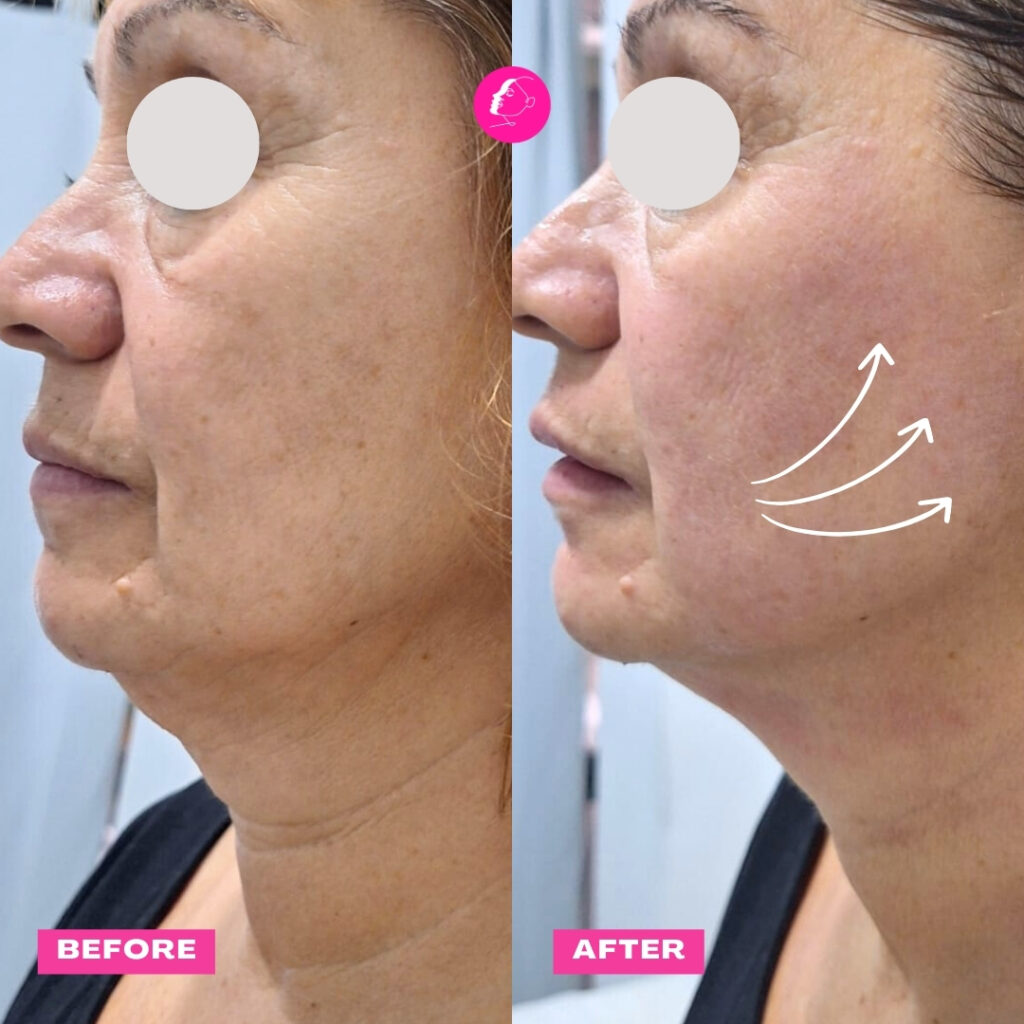 Antes y después de HIFU 8D Facial